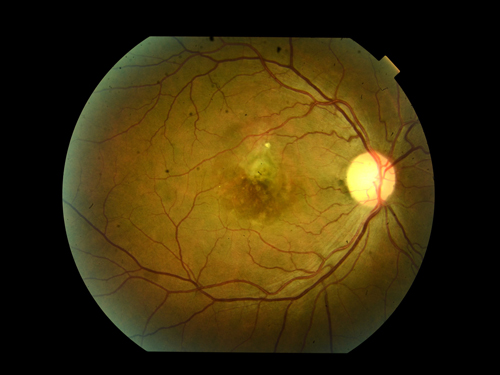 NewVision Fundus
